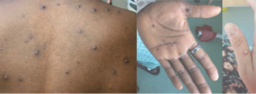 What Do You Need to Know about Monkeypox? - Abdi Waluyo Hospital