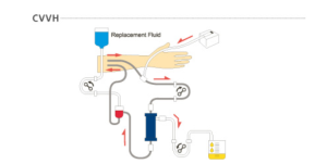 Hemodialysis for 24 Hours? Get to Know What Continuous Veno-Venous ...