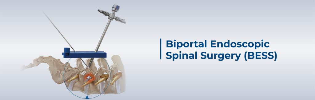 Ketahui Metode Biportal Endoscopic Spinal Surgery (BESS) untuk ...