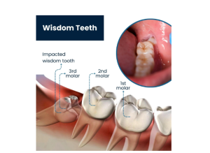 Wisdom Teeth 101: Understanding Their Purpose and When Surgery is ...