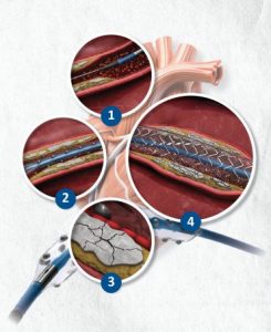 Intravascular Lithotripsy (IVL): Breaking Through Calcium Blockages in ...